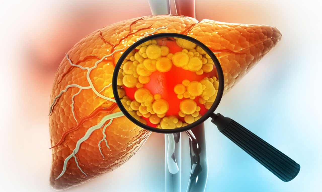 Entendendo a Esteatose Hepática: "Gordura no Fígado" e a Importância do ...